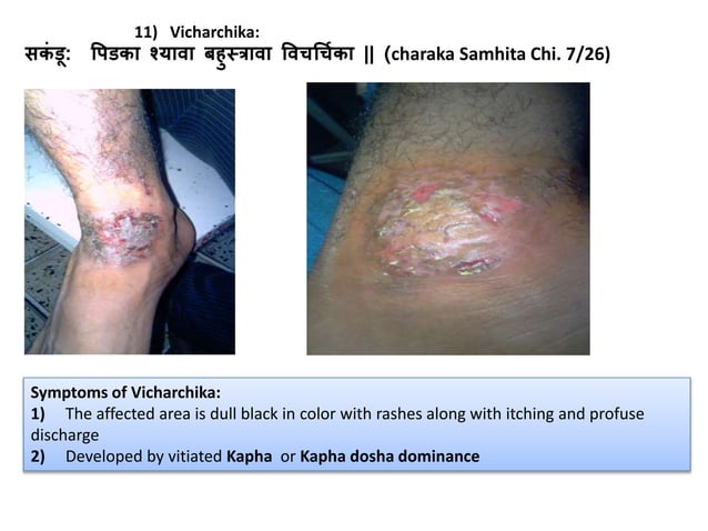 Kustha | PPTX | Skin and Dermatology | Diseases and Conditions