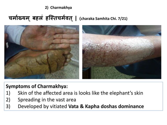 Kustha | PPTX | Skin and Dermatology | Diseases and Conditions