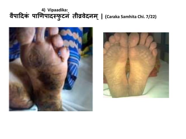Kustha | PPTX | Skin and Dermatology | Diseases and Conditions