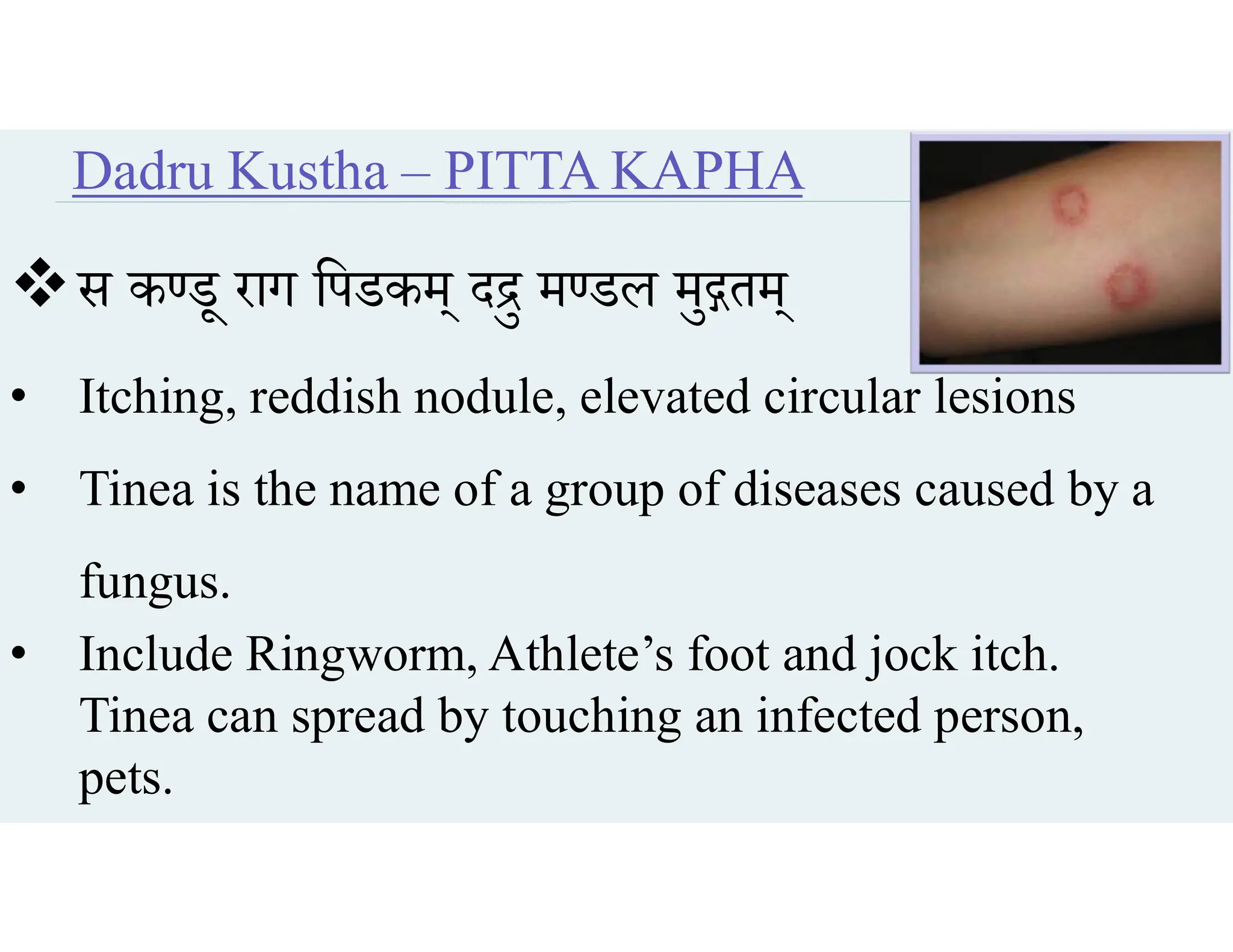 KUSTHA PPT .pdf KUSTHA definition, classification, and modern probable ...