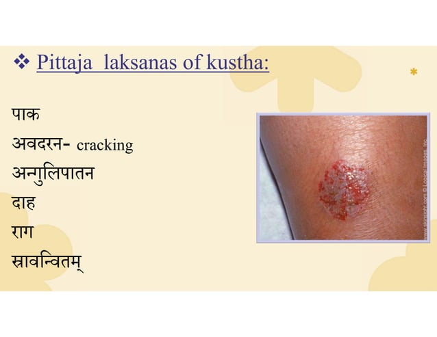 KUSTHA PPT .pdf KUSTHA definition, classification, and modern probable ...
