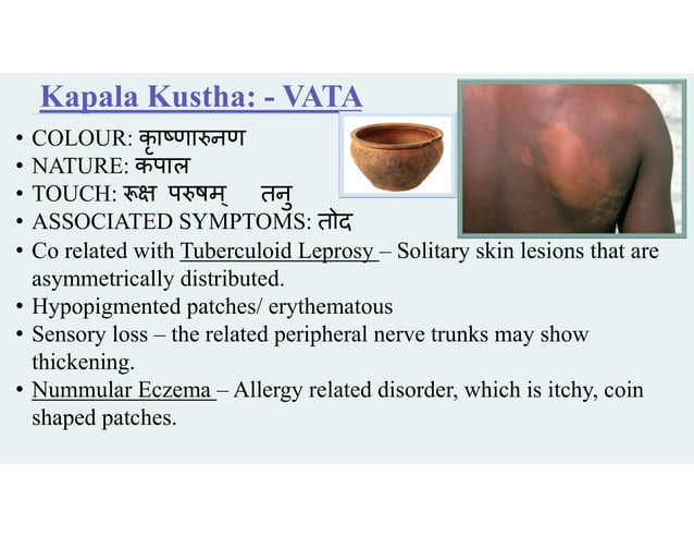 KUSTHA PPT .pdf KUSTHA definition, classification, and modern probable ...