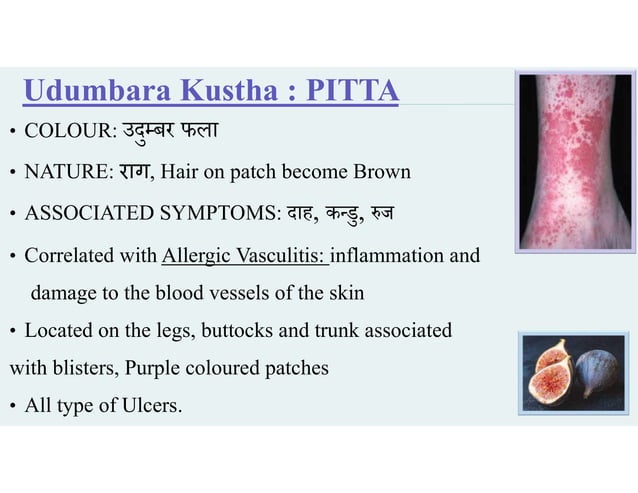 KUSTHA PPT .pdf KUSTHA definition, classification, and modern probable ...