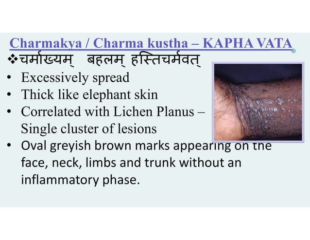 KUSTHA PPT .pdf KUSTHA definition, classification, and modern probable ...