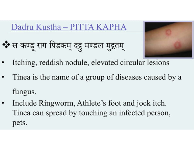 KUSTHA PPT .pdf KUSTHA definition, classification, and modern probable ...