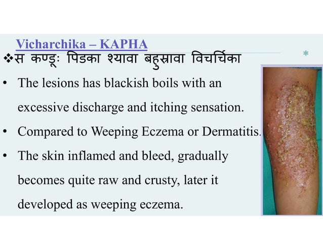 KUSTHA PPT .pdf KUSTHA definition, classification, and modern probable ...