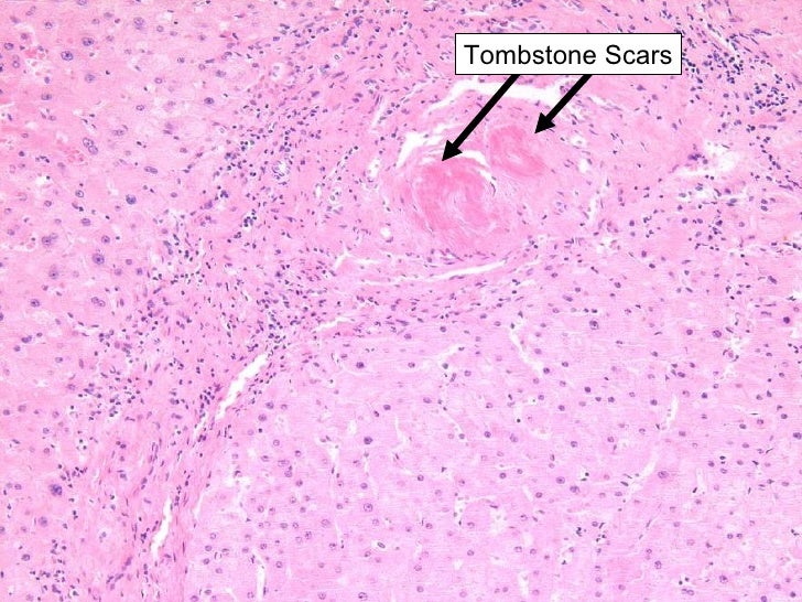 Autoimmune Liver Disease - Kuwait