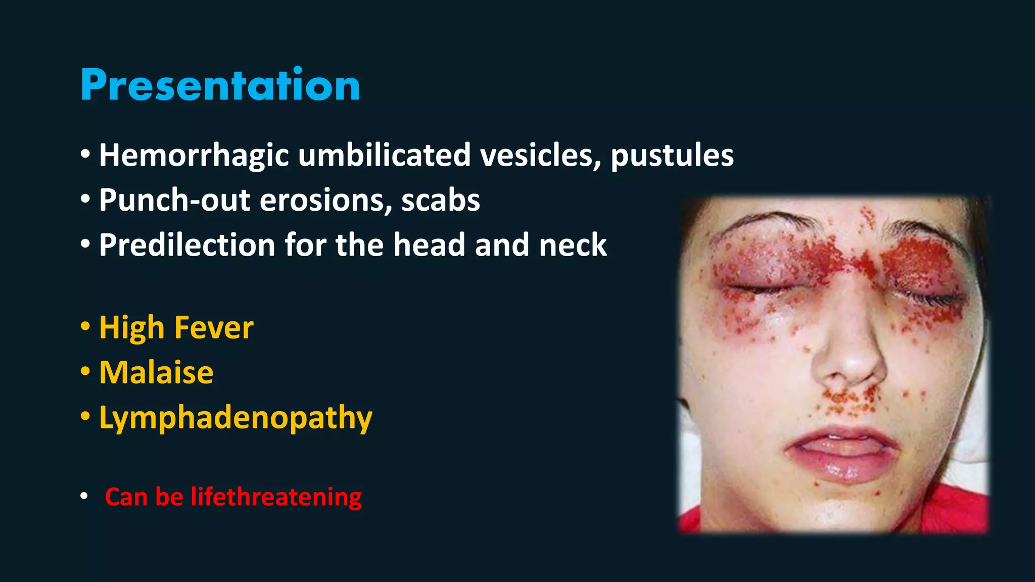 Kaposi Varicelliform Eruption | PPTX