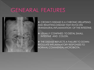 Crohn,s disease | PDF