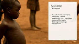 Kwarshirkor Presentation by BOUZAHER AYMEN ABDERRAHMANE | PDF