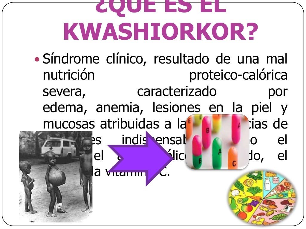 Kwashiorkor