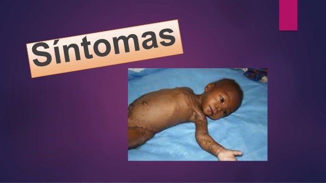 Kwashiorkor