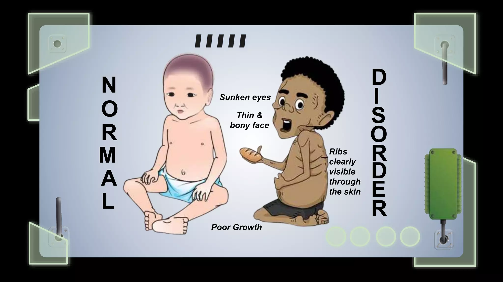 KWASHIORKOR-MARASMUS-GROUP-4-1.pptx