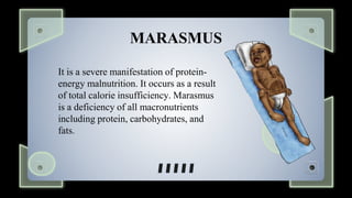 KWASHIORKOR-MARASMUS-GROUP-4-1.pptx