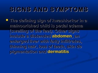 Kwashiorkor2 | PPT