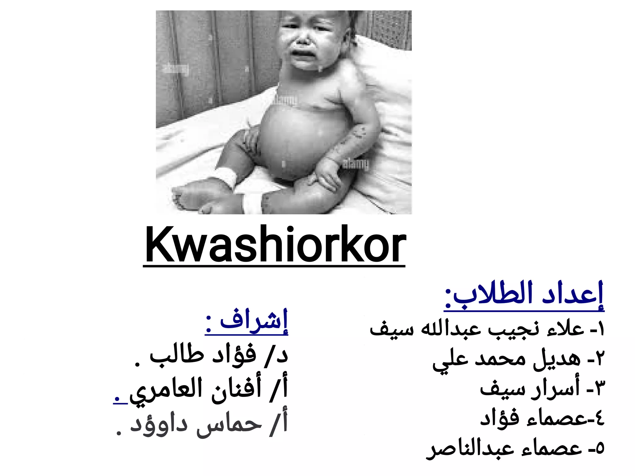 kwashiorkor disease .pdf