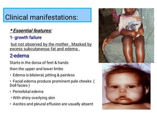kwashiorkor disease .pdf