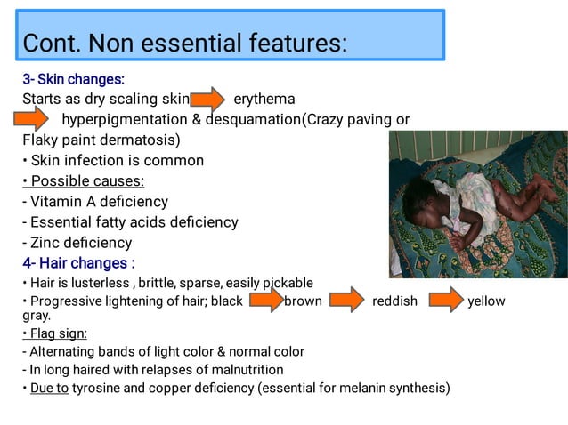 kwashiorkor disease .pdf | Digestive Disorders | Diseases and Conditions