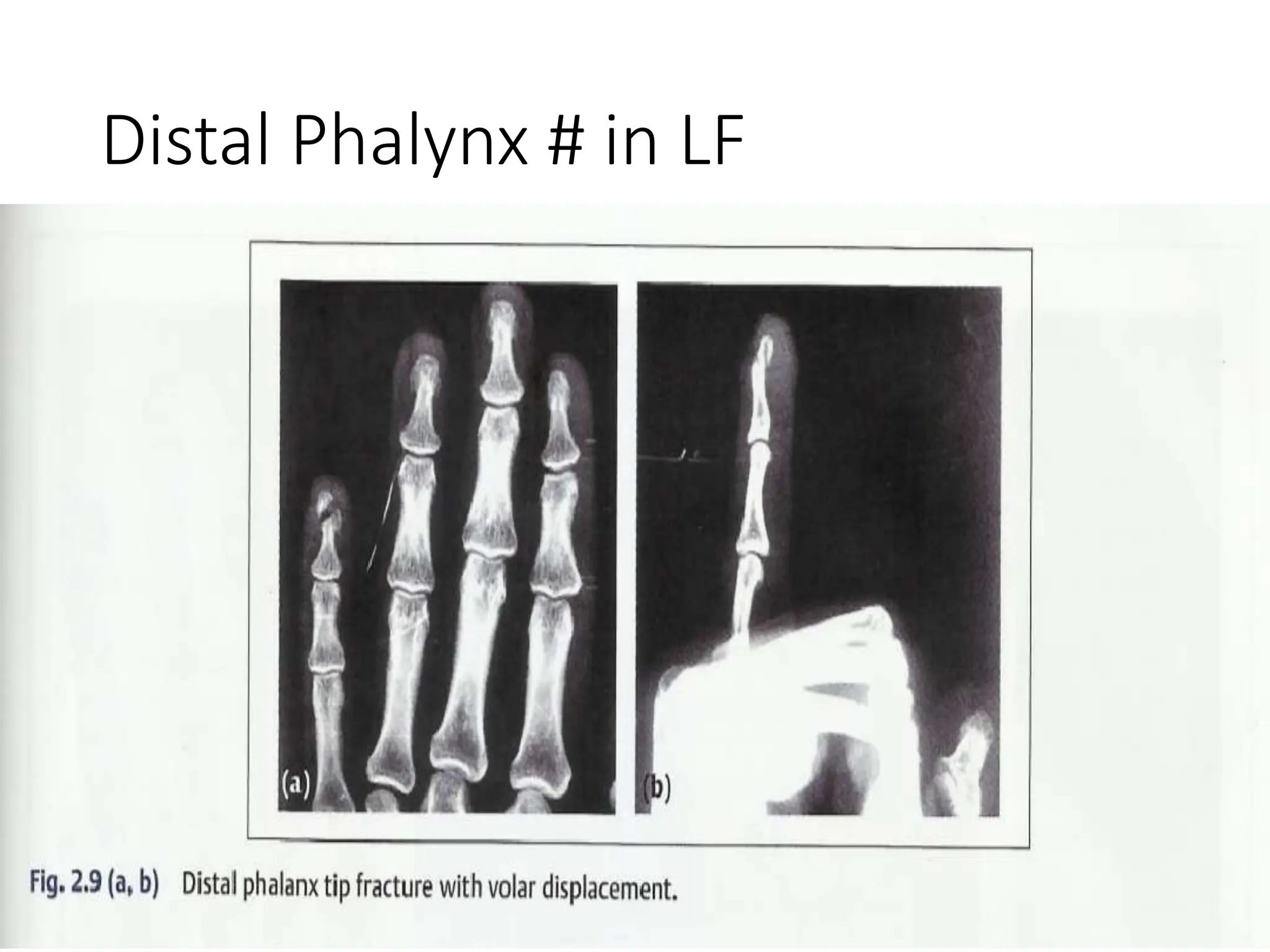 K WIRE FIXATION-Basics.pptx