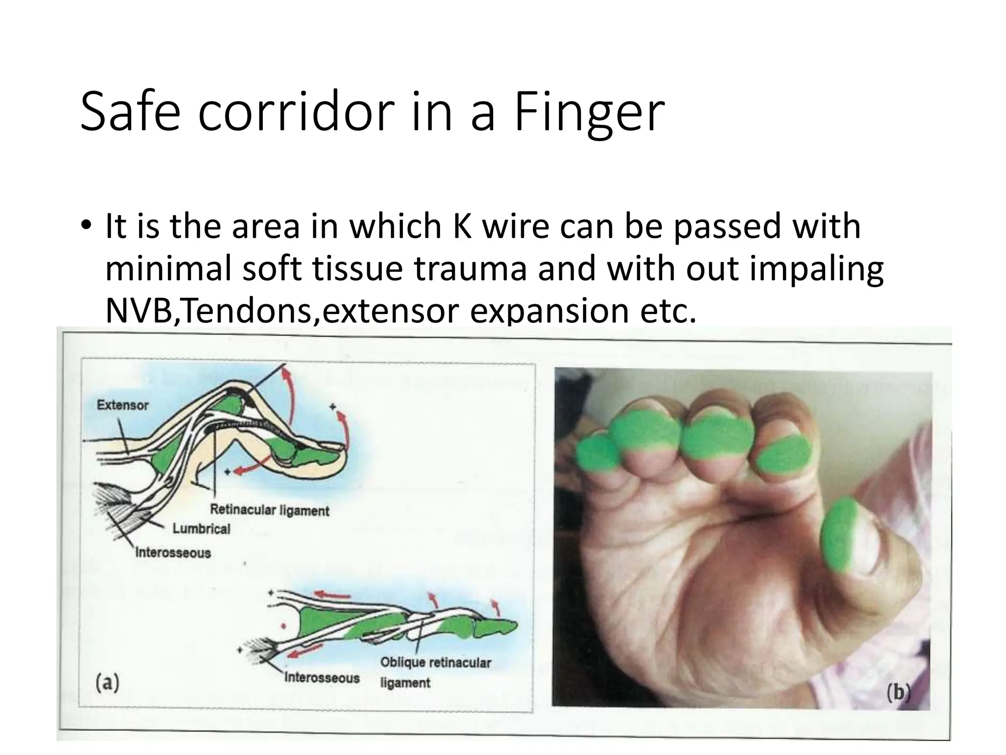 K WIRE FIXATION-Basics.pptx
