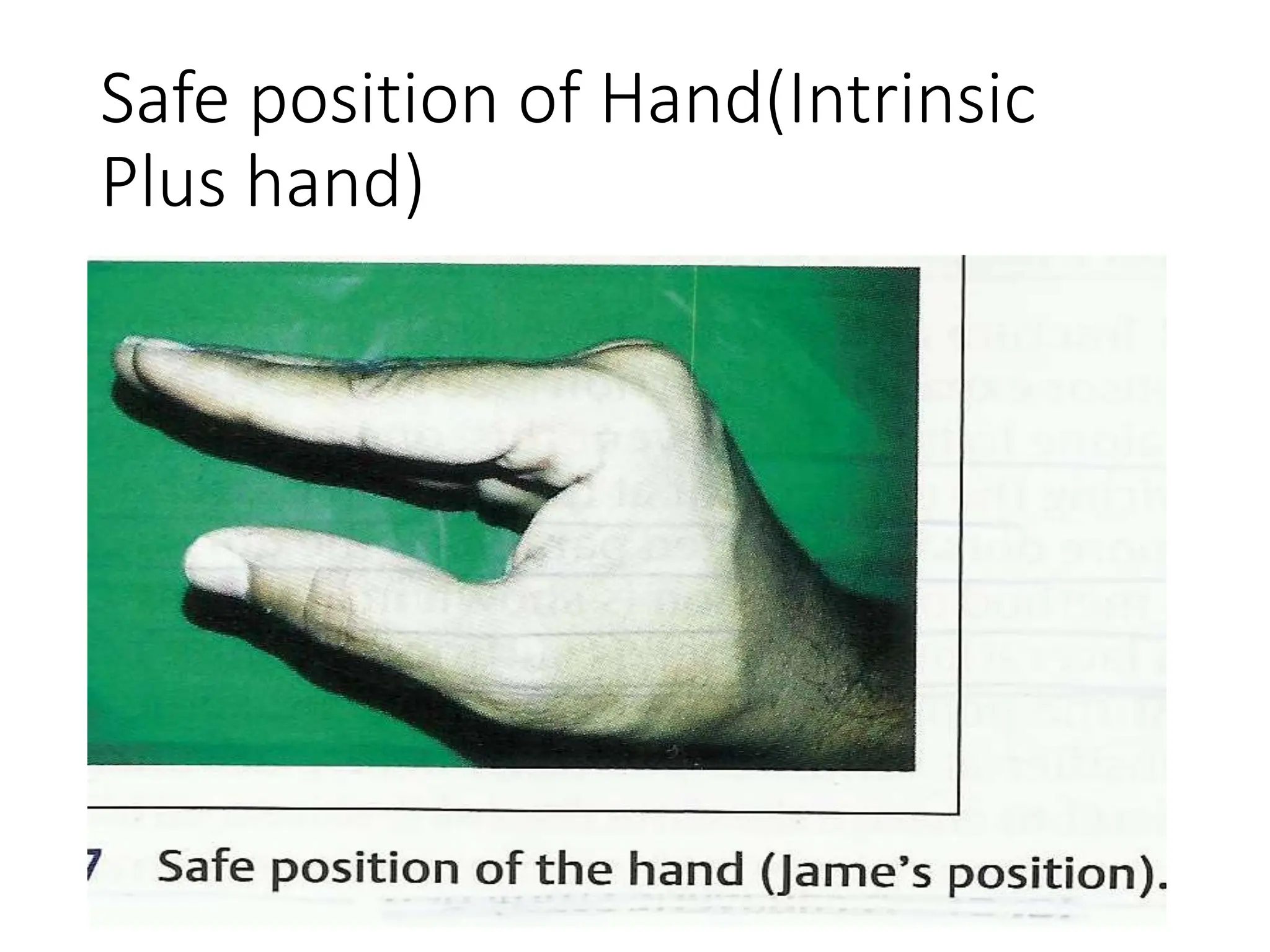 K WIRE FIXATION-Basics.pptx