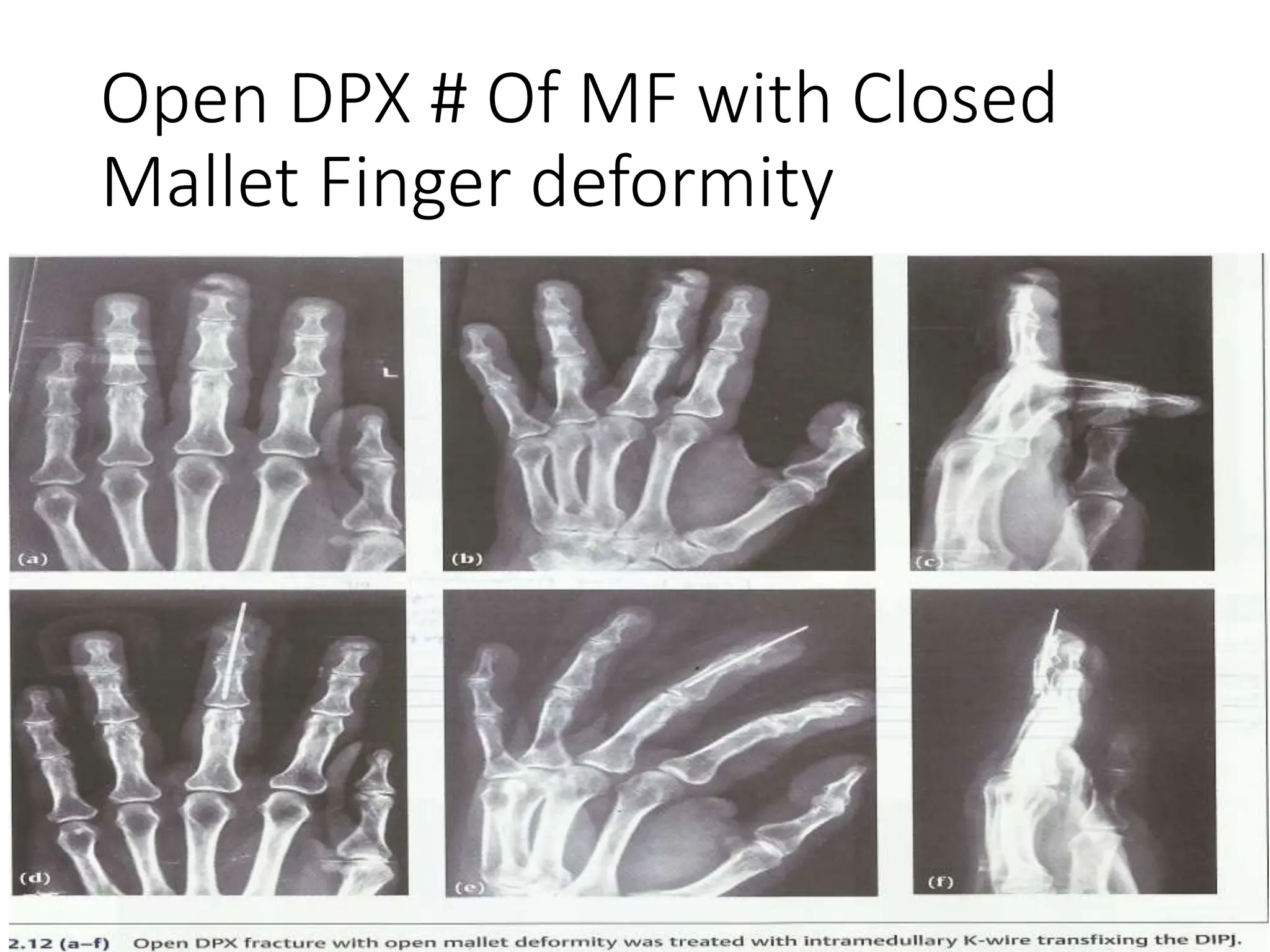 K WIRE FIXATION-Basics.pptx