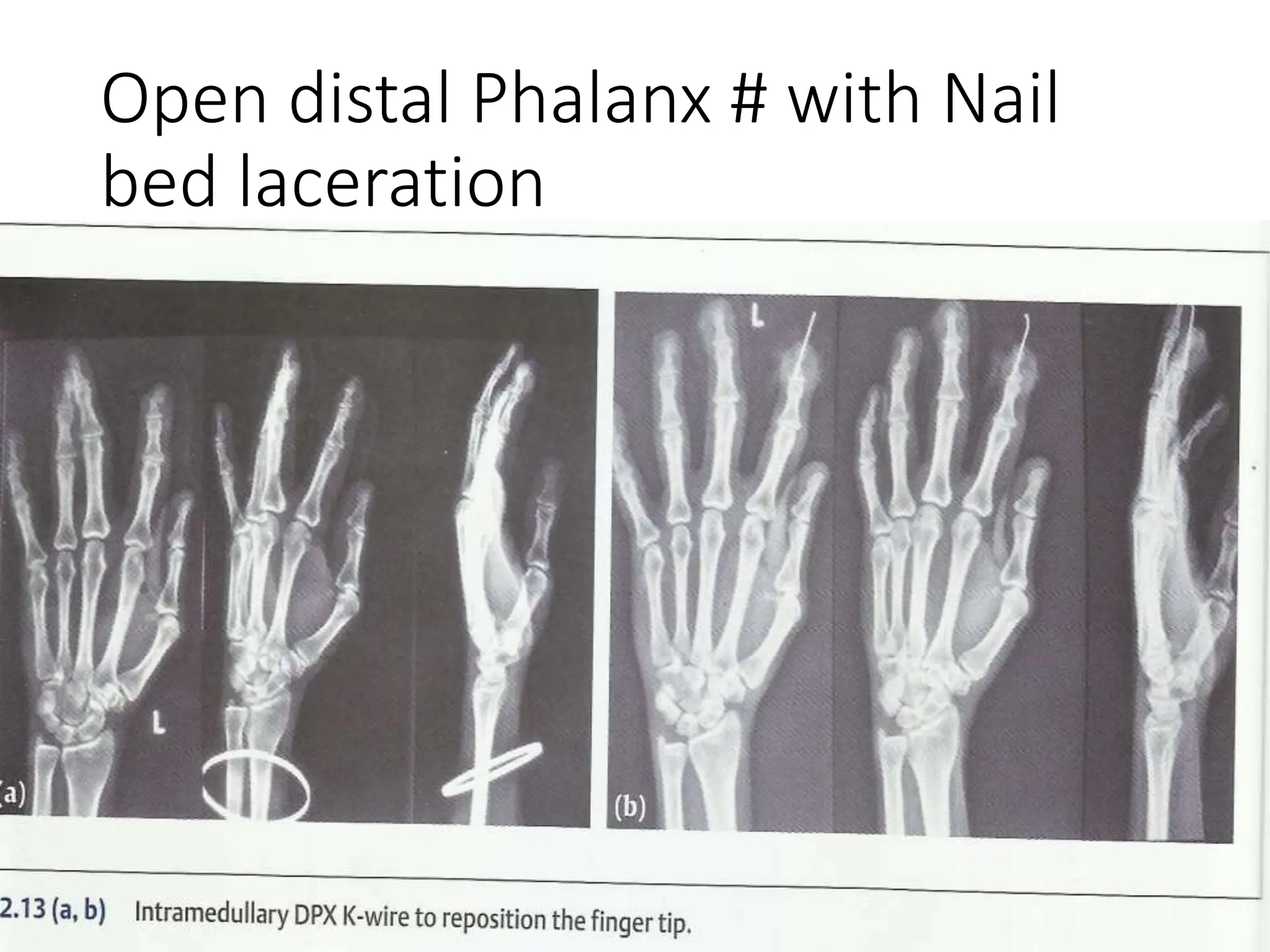 K WIRE FIXATION-Basics.pptx