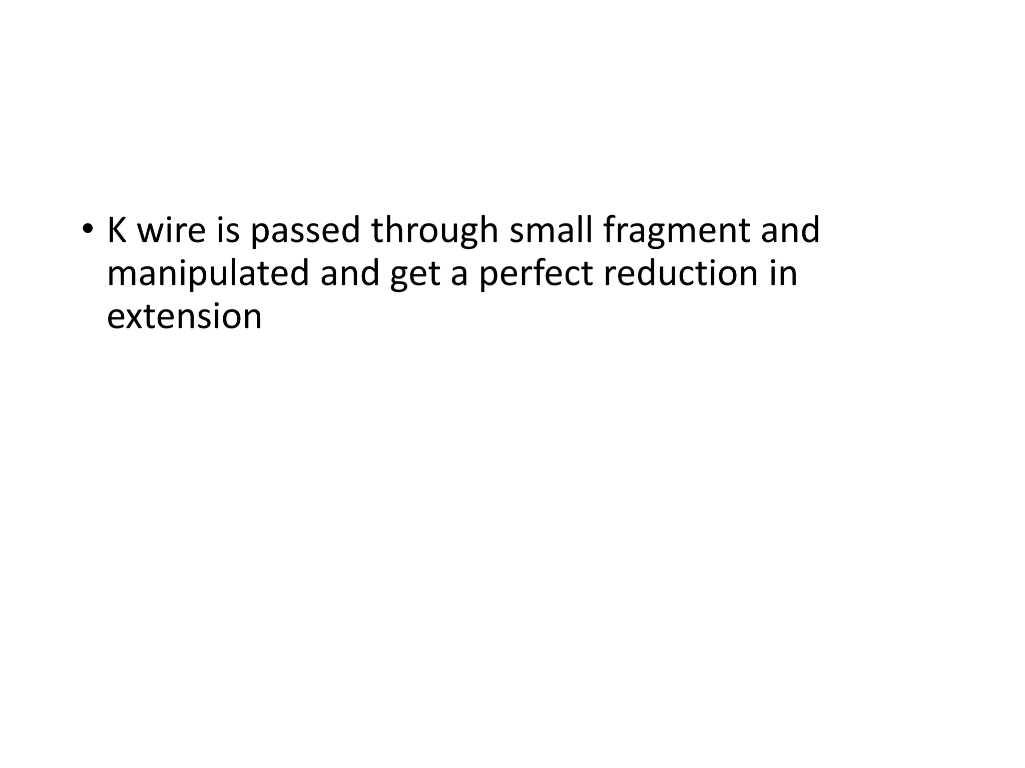 K WIRE FIXATION-Basics.pptx