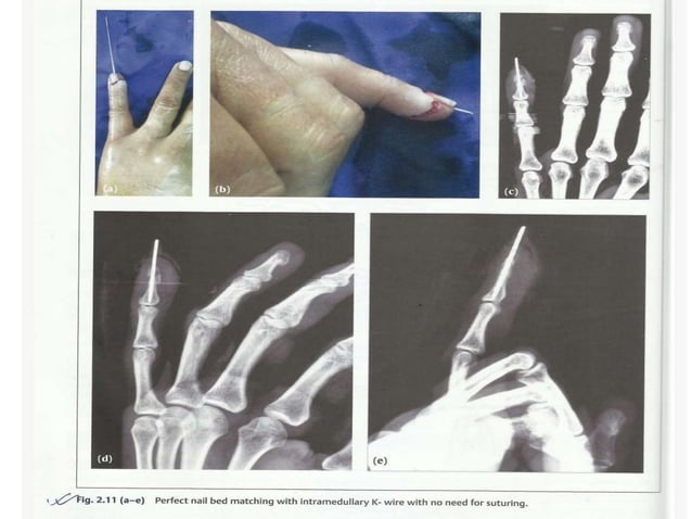 K WIRE FIXATION-Basics.pptx | First Aid | Injuries