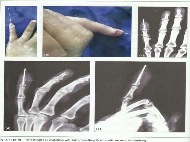 K WIRE FIXATION-Basics.pptx | First Aid | Injuries