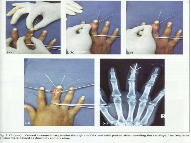 K WIRE FIXATION-Basics.pptx | First Aid | Injuries