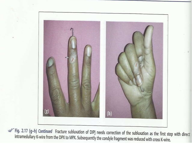 K WIRE FIXATION-Basics.pptx | First Aid | Injuries