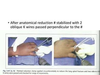 K WIRE FIXATION-Basics.pptx