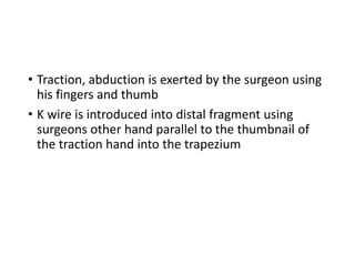 K WIRE FIXATION-Basics.pptx