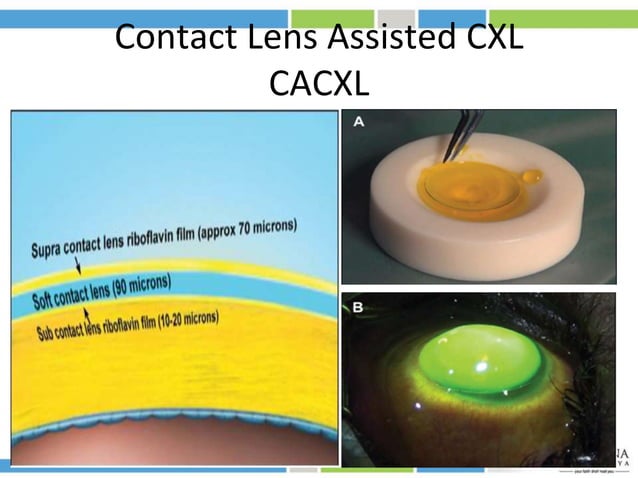 Collagen Crosslinking Pptx