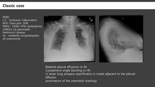 Pleural effusion | PPTX