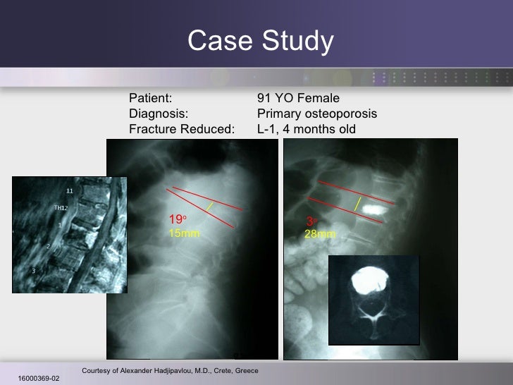 Post Op Kyphoplasty Icd 10 _ Care and Recovery after a Kyphoplasty – UBBK