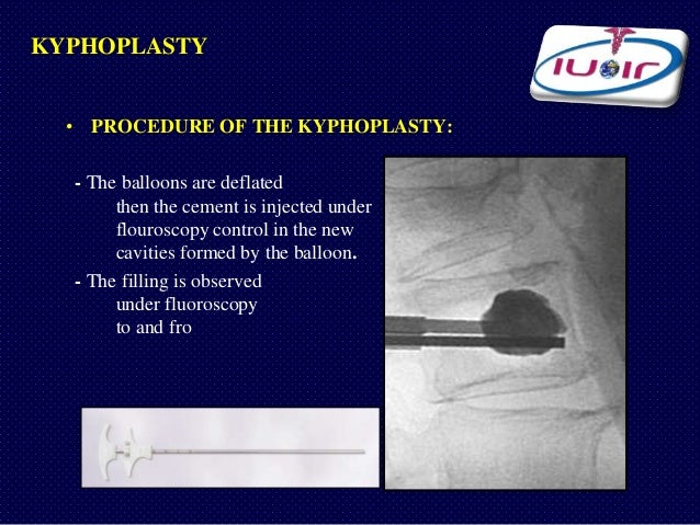 Kyphoplasty. Department of Pr Laredo