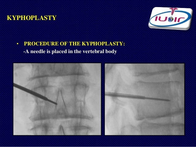 Kyphoplasty. Department of Pr Laredo