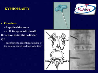 Kyphoplasty2 | PDF