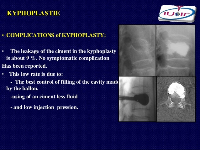 Kyphoplasty2