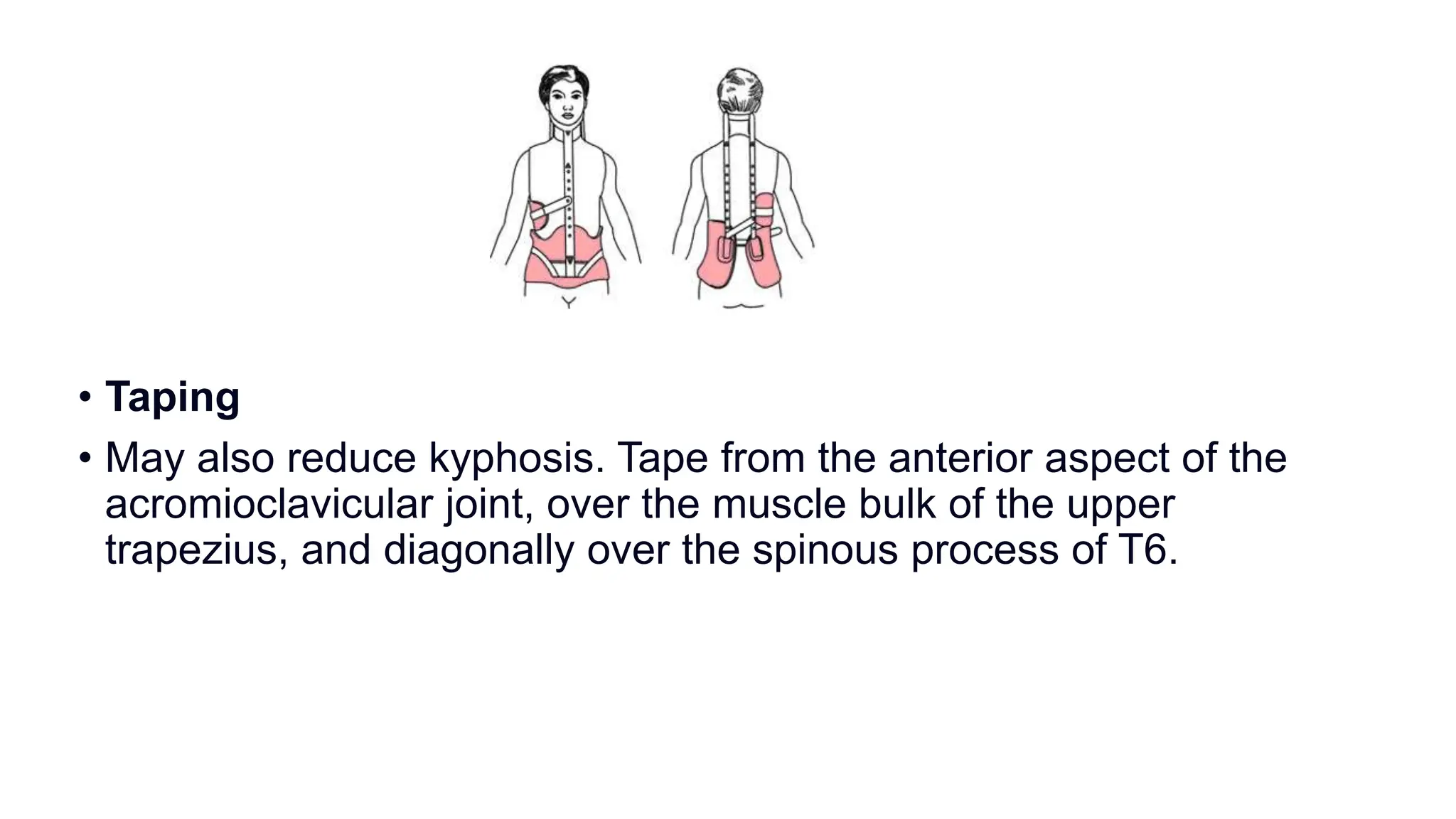 KYPHOSIS-1.pptx biomechanics. ........... | PPTX