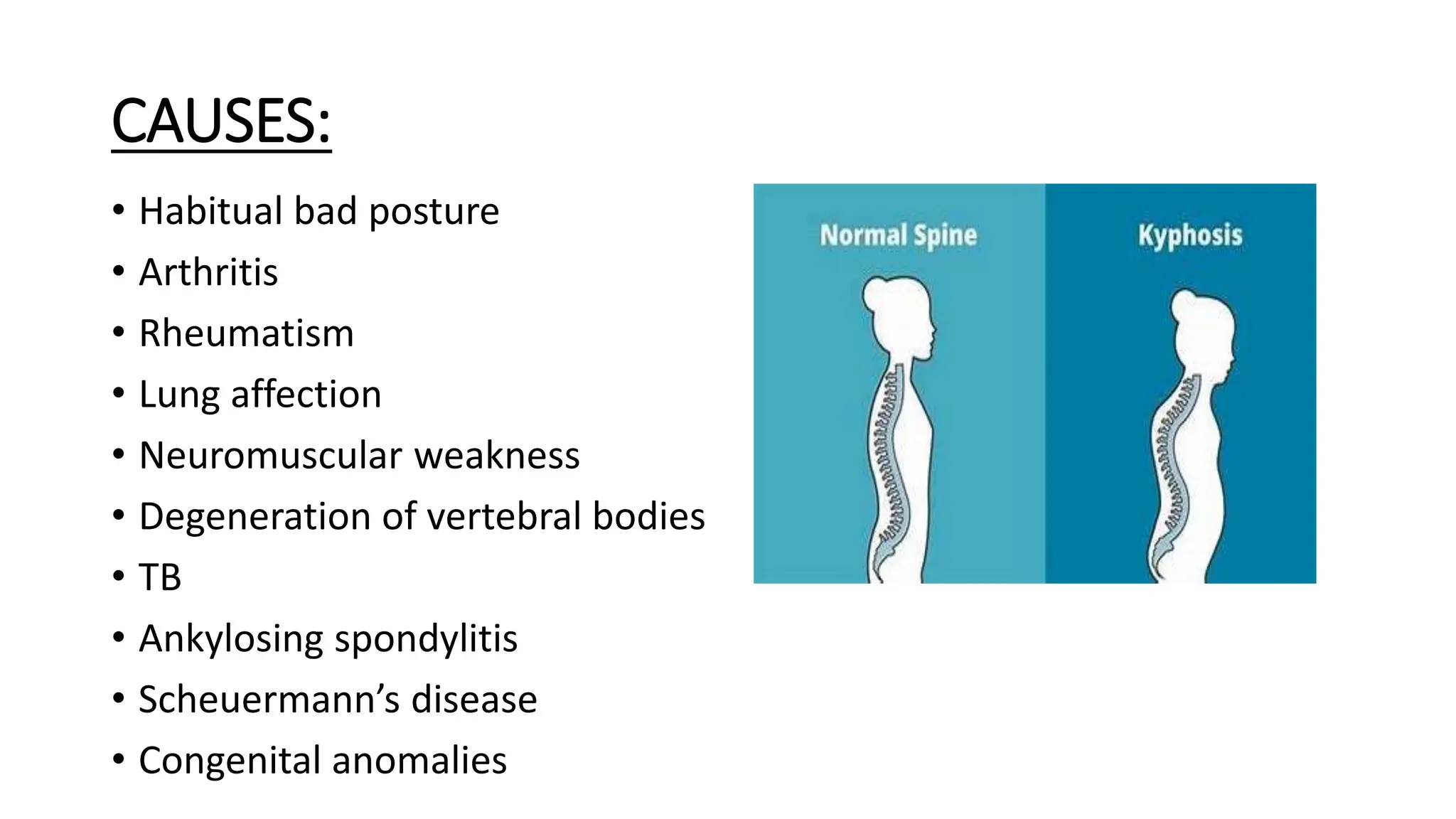KYPHOSIS-1.pptx biomechanics. ........... | PPTX