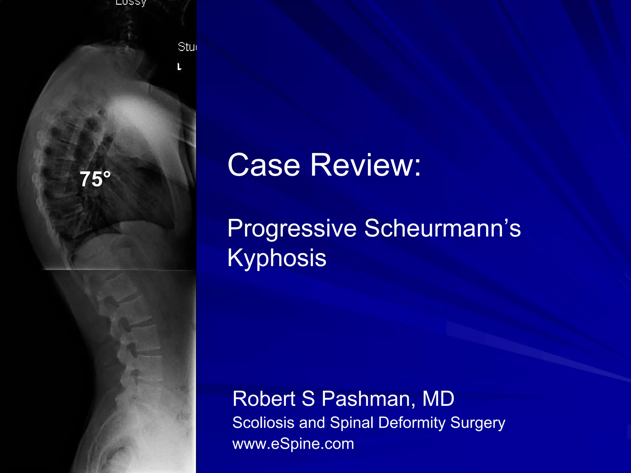 Case Review #3: 17 year old male with Scheurmann's Kyphosis | PDF