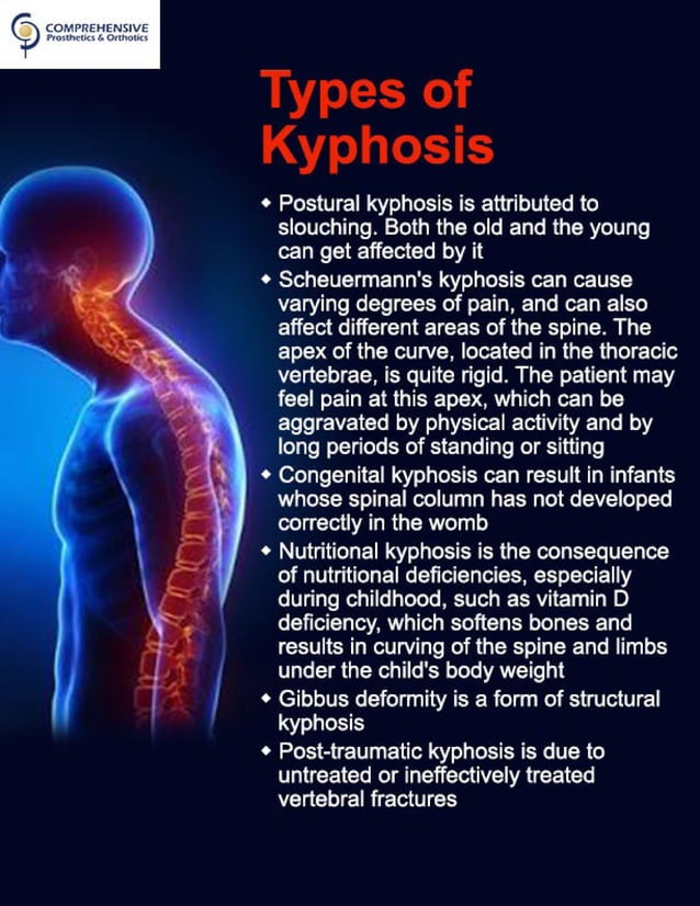 Kyphosis | PDF