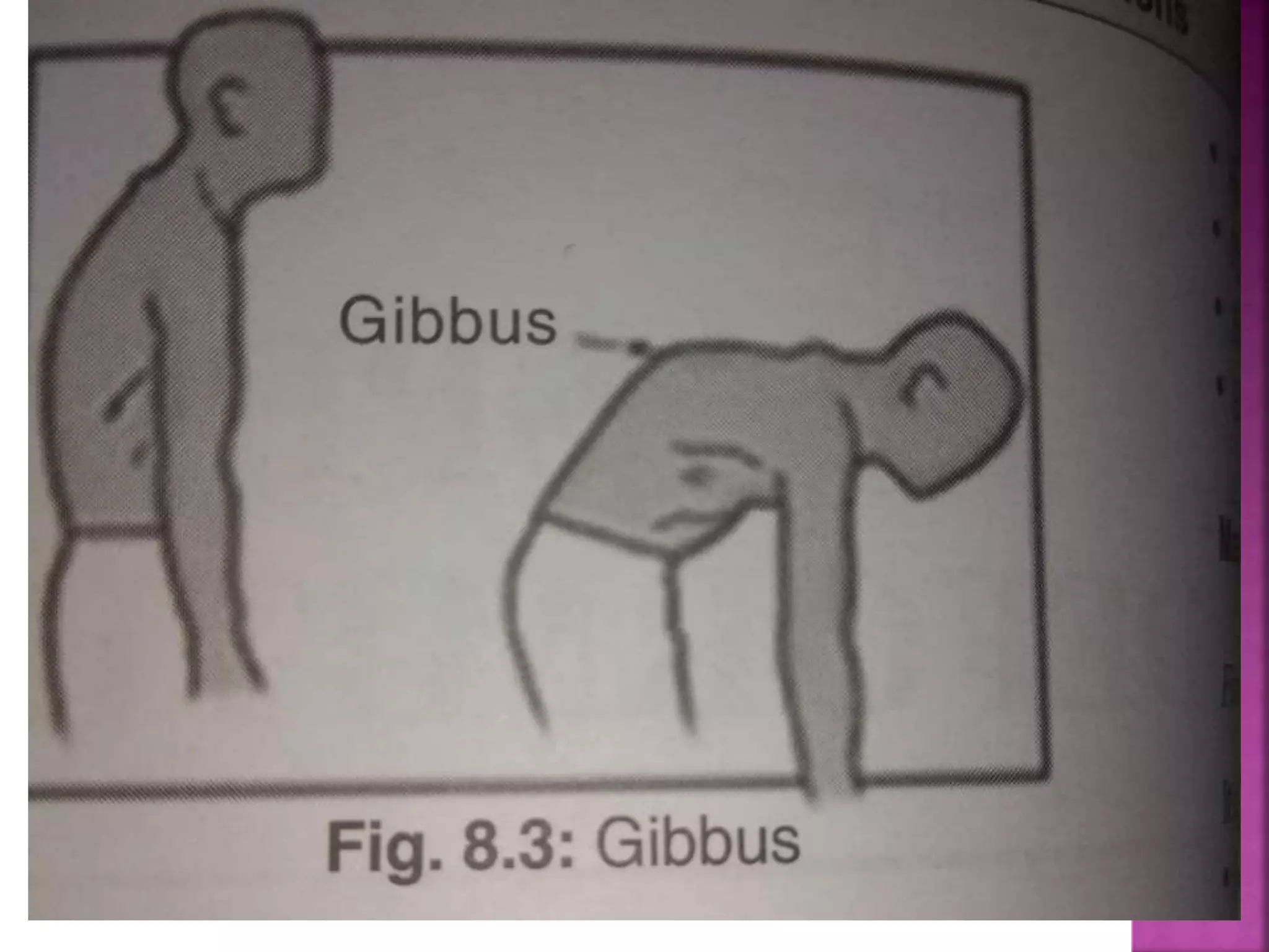 Kyphosis | PPTX