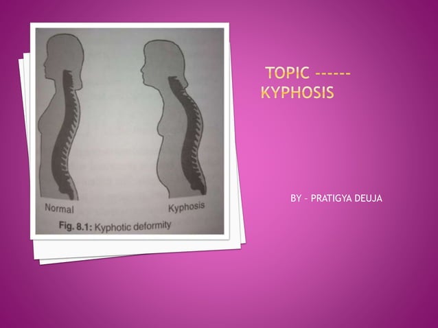 Kyphosis | PPTX