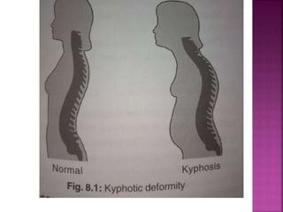 Kyphosis | PPTX