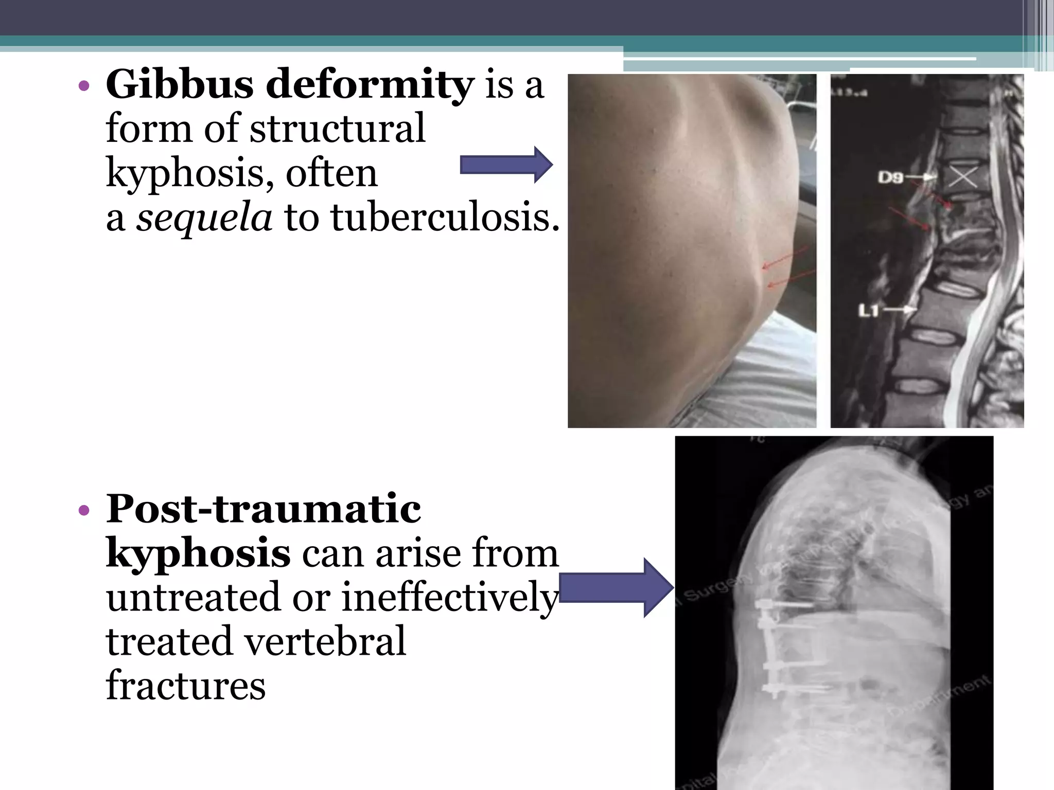 Kyphosis | PPTX