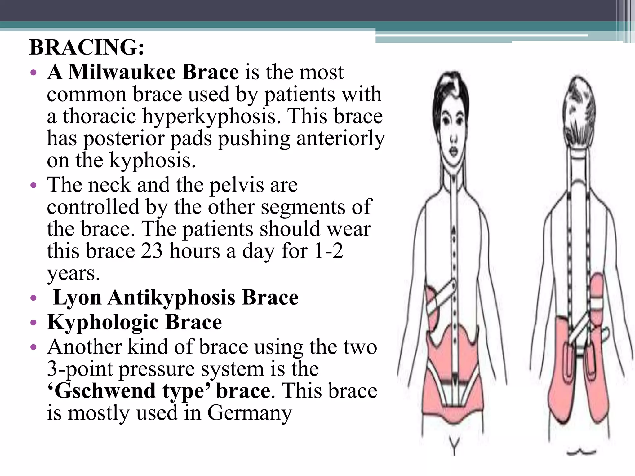 Kyphosis | PPTX